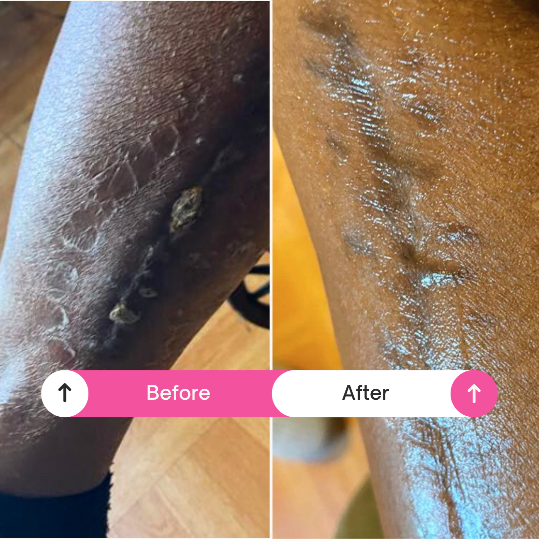 Luxury Eczema Skincare for Sensitive Skin | by A’amia – by A'amia Skin ...